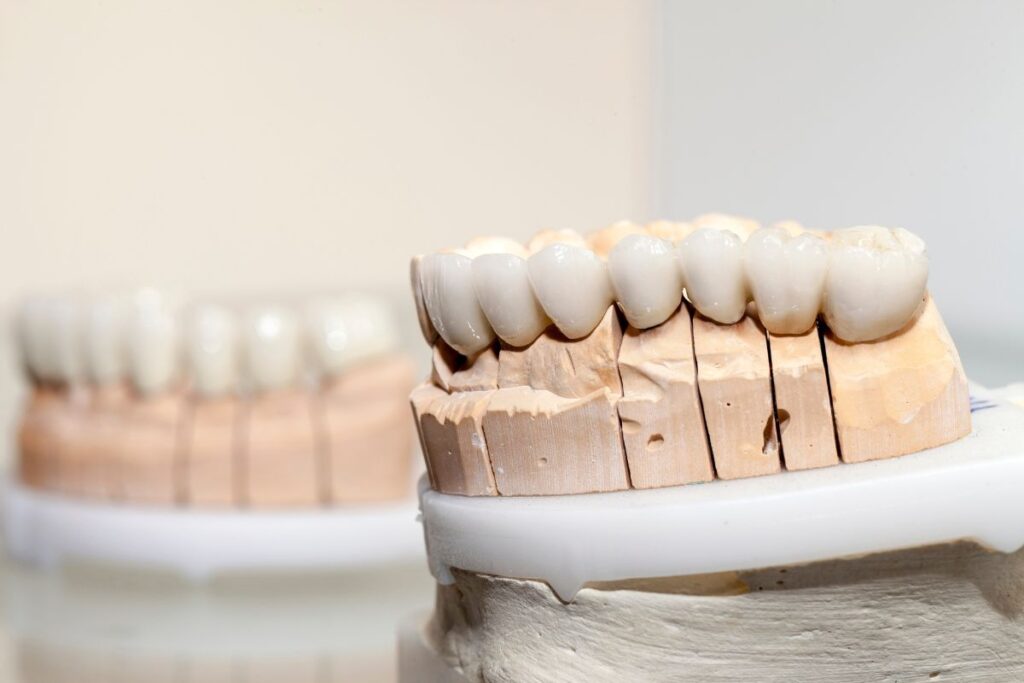 Can You Take a Crown Off and Put It Back On? - Mose Family Dentistry