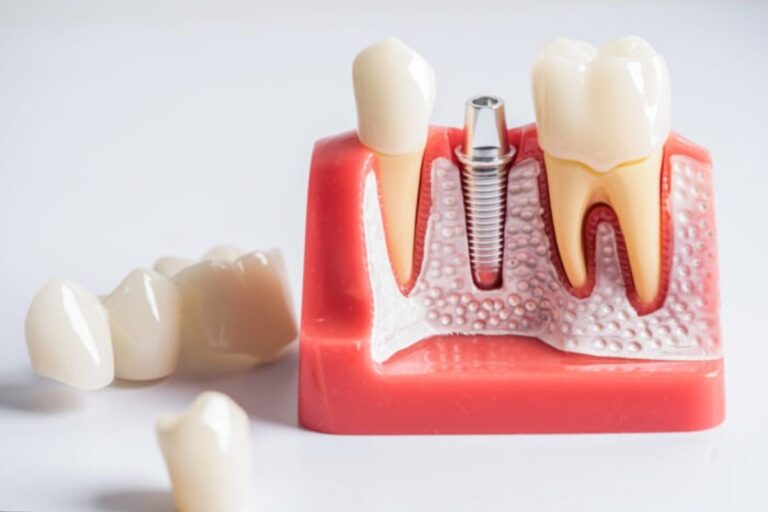 Can You Take a Crown Off and Put It Back On? - Mose Family Dentistry